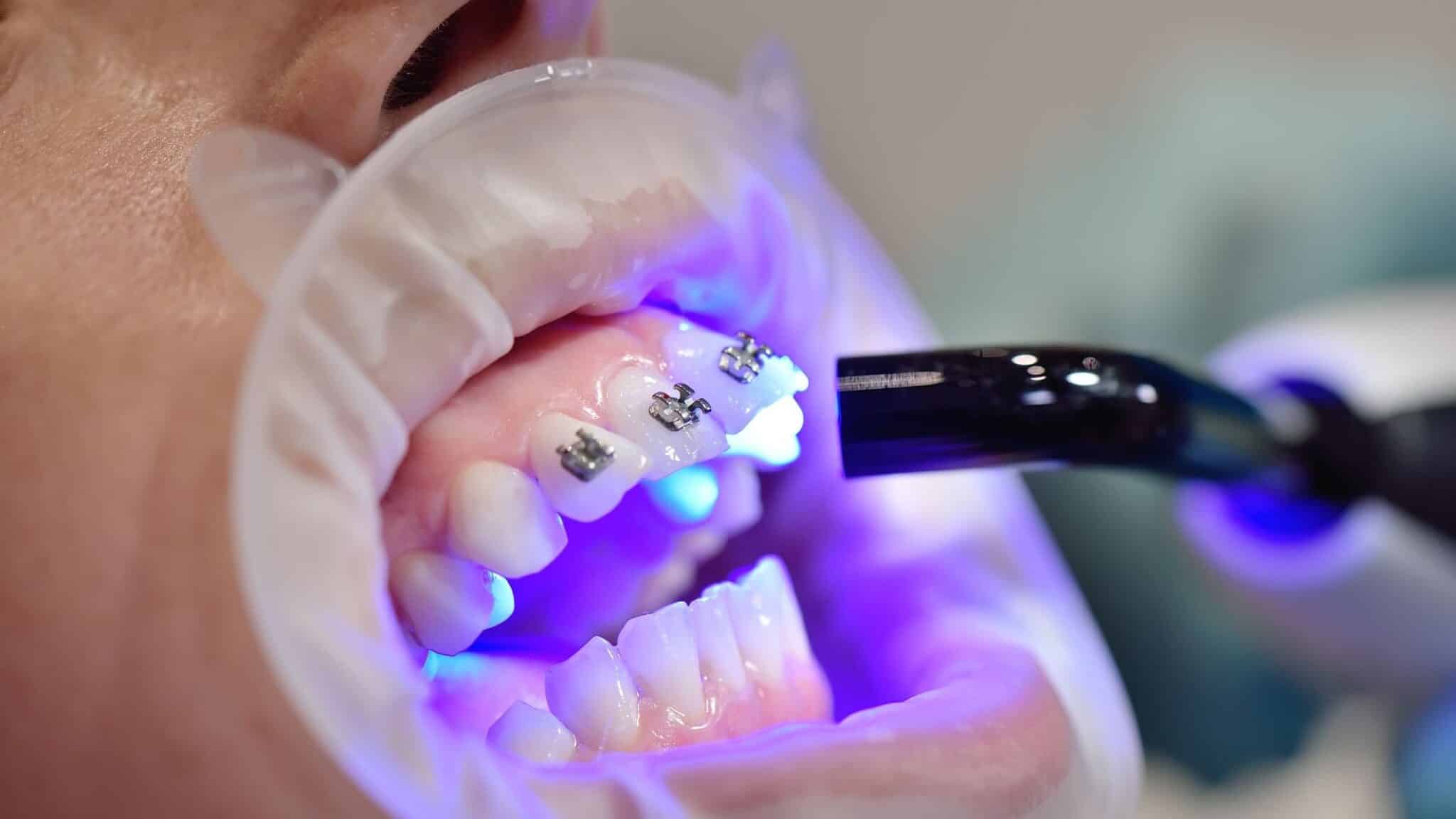 Tipos de brackets y como se ponen - Viena