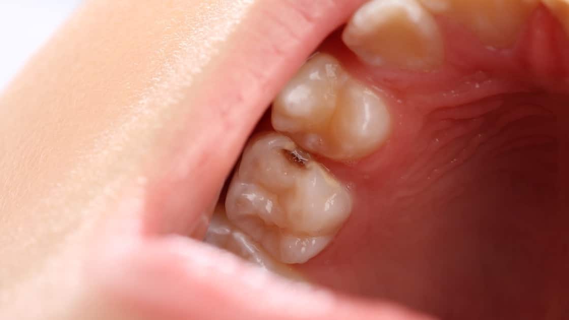 Cavity Symptoms 101: How to Recognize the Most Common Signs