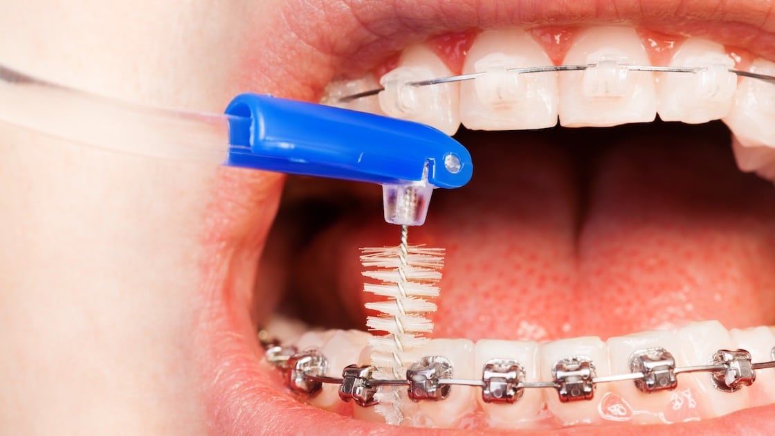 Como cepillarse los dientes con brackets - Consejos!
