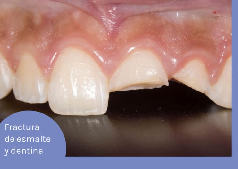 Breaking Down Dental Fractures: Guide to Treatment and Recovery