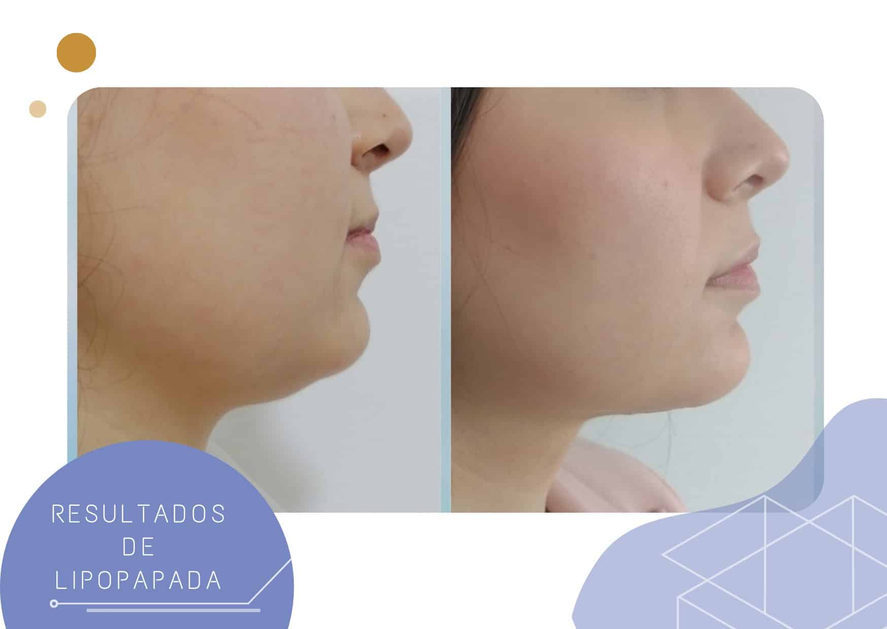 Lipopapada con enzimas vs lipopapada quirúrgica - Viena
