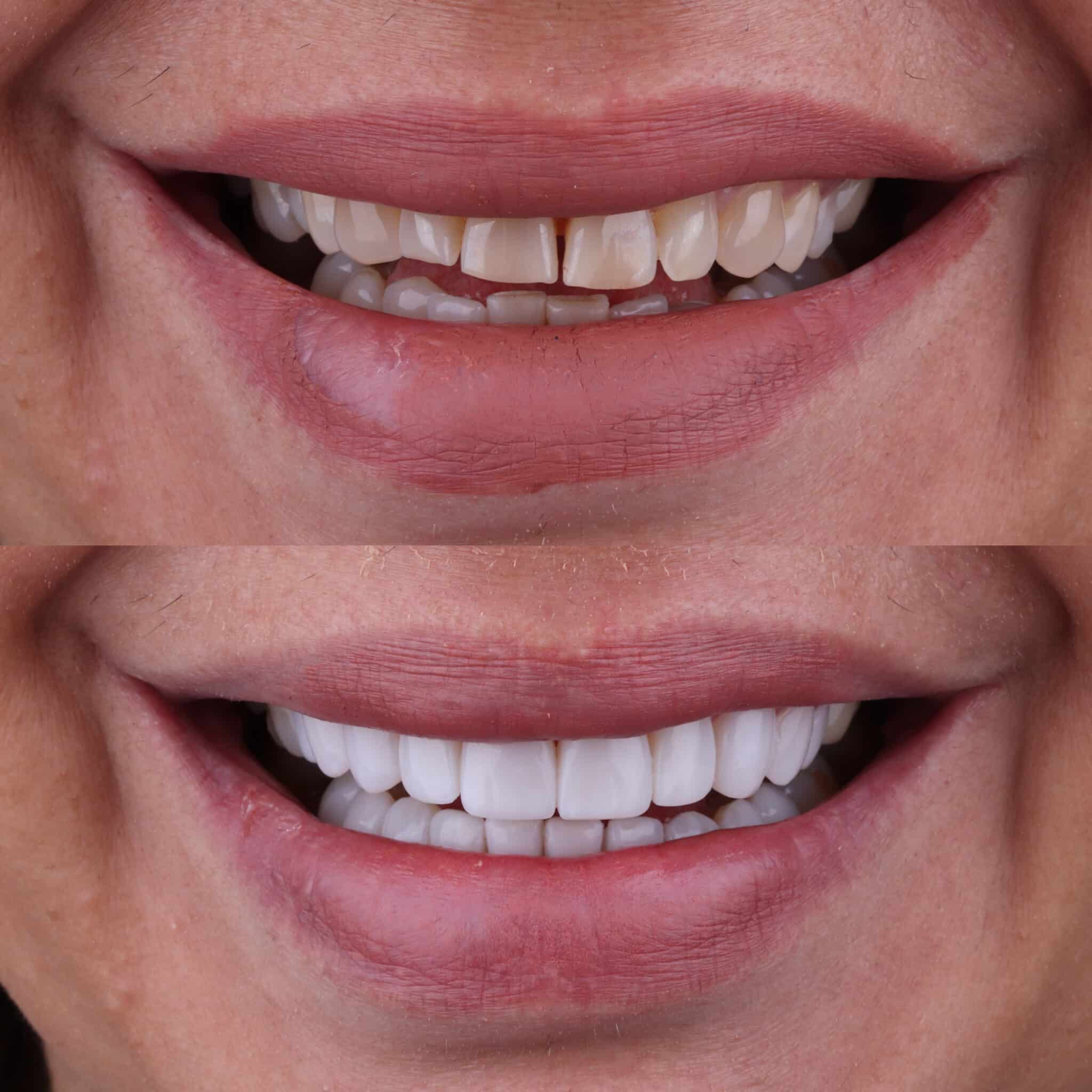 Veneers Before and After: Real Transformations