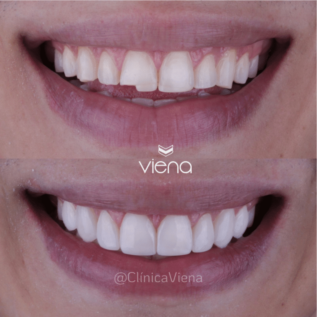 Veneers Before and After: Real Transformations