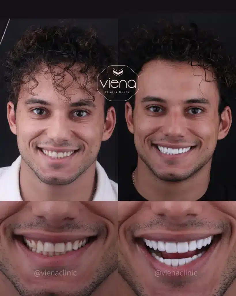 Veneers in Colombia | E-max from $4,950 + Triple Guarantee